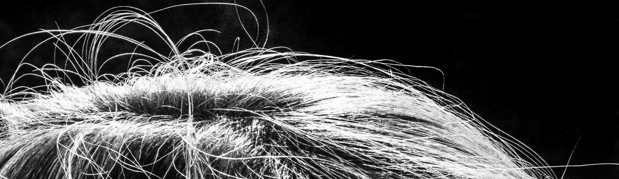 Mésothé du cuir chevelu - Dr Meulebrouck - Cabinet de médecine ...